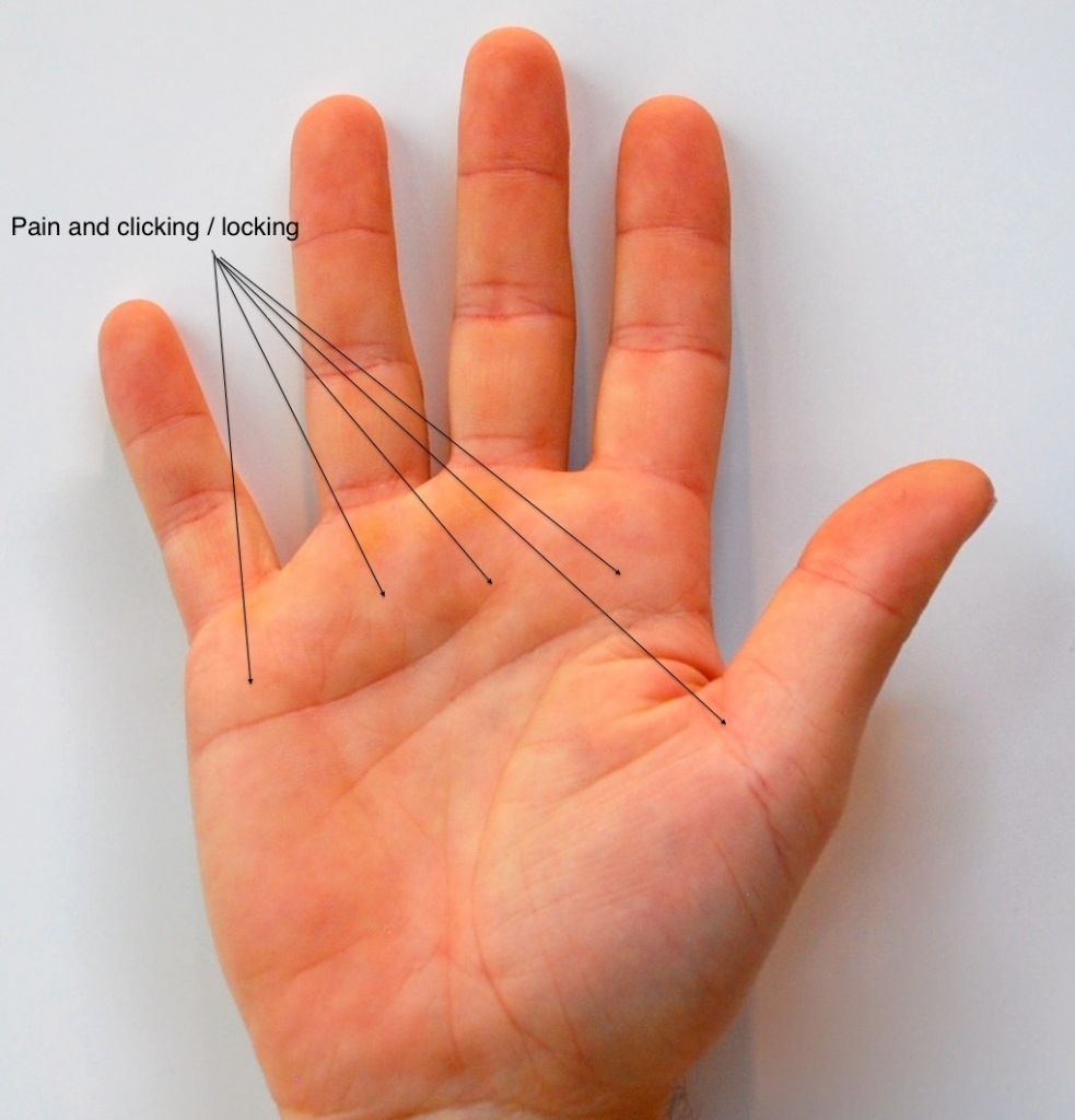 Hands – Soft Tissue Pathologies « Oxford Orthopaedics